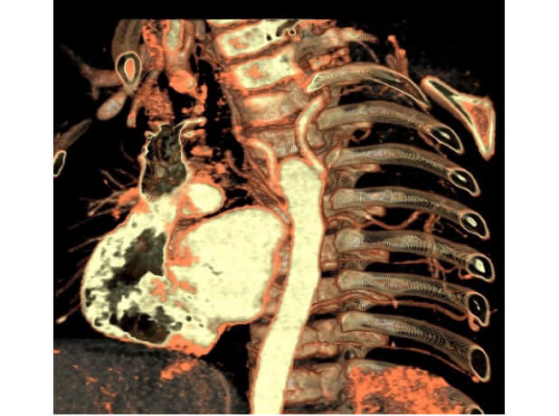 Aortic coarctation - CT angiography - Perfusfind