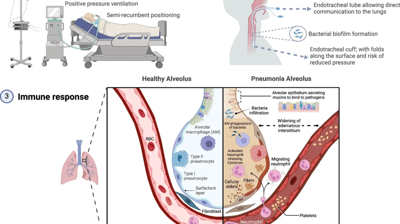 Ventilator-associated pneumonia: pathobiological heterogeneity and ...