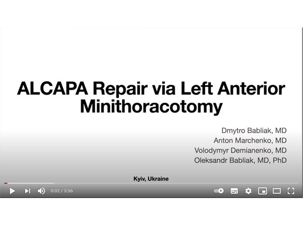 ALCAPA, Repair via Left Anterior Minithoracotomy - Perfusfind