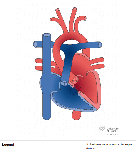 Perimembranous ventricular septal defect (VSD) - Perfusfind