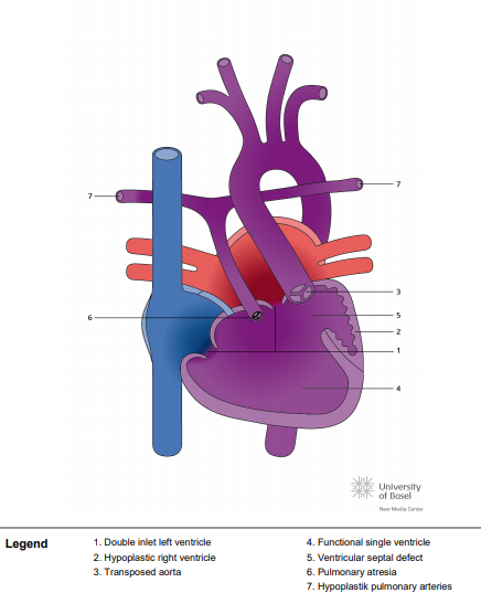 Double inlet left ventricle (DILV) with transposed great arteries (TGA ...