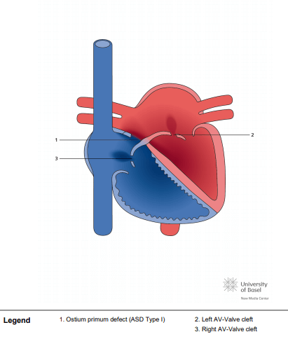 Partial atrioventricular septal defect (ASD Type I, Ostium primum ...