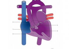Mesocardia - Congenital cardiopathie- Perfusfind.com