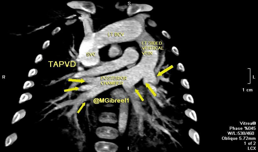 Unobstructed TAPVR supracardiac type - Perfusfind