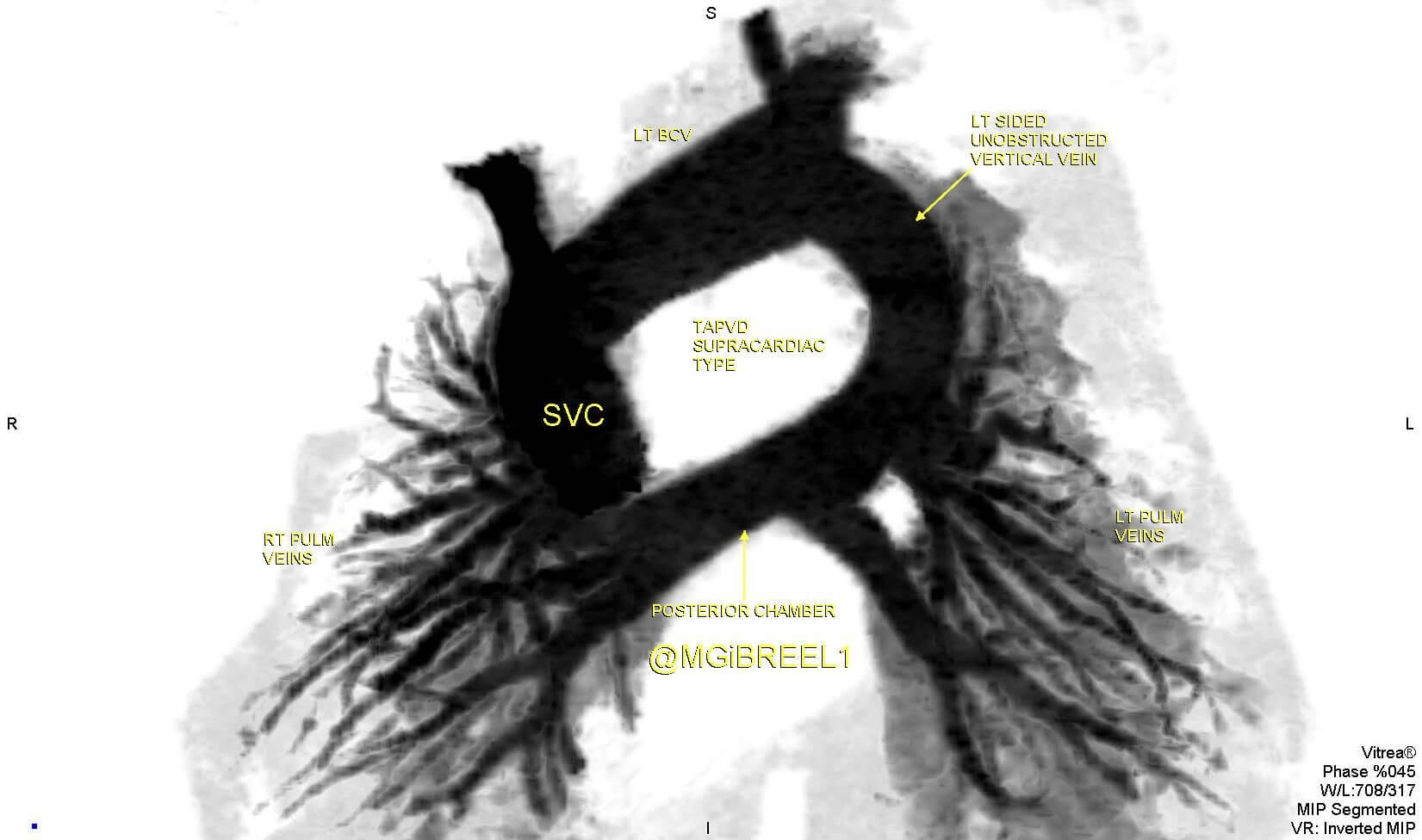 Unobstructed TAPVR supracardiac type - Perfusfind