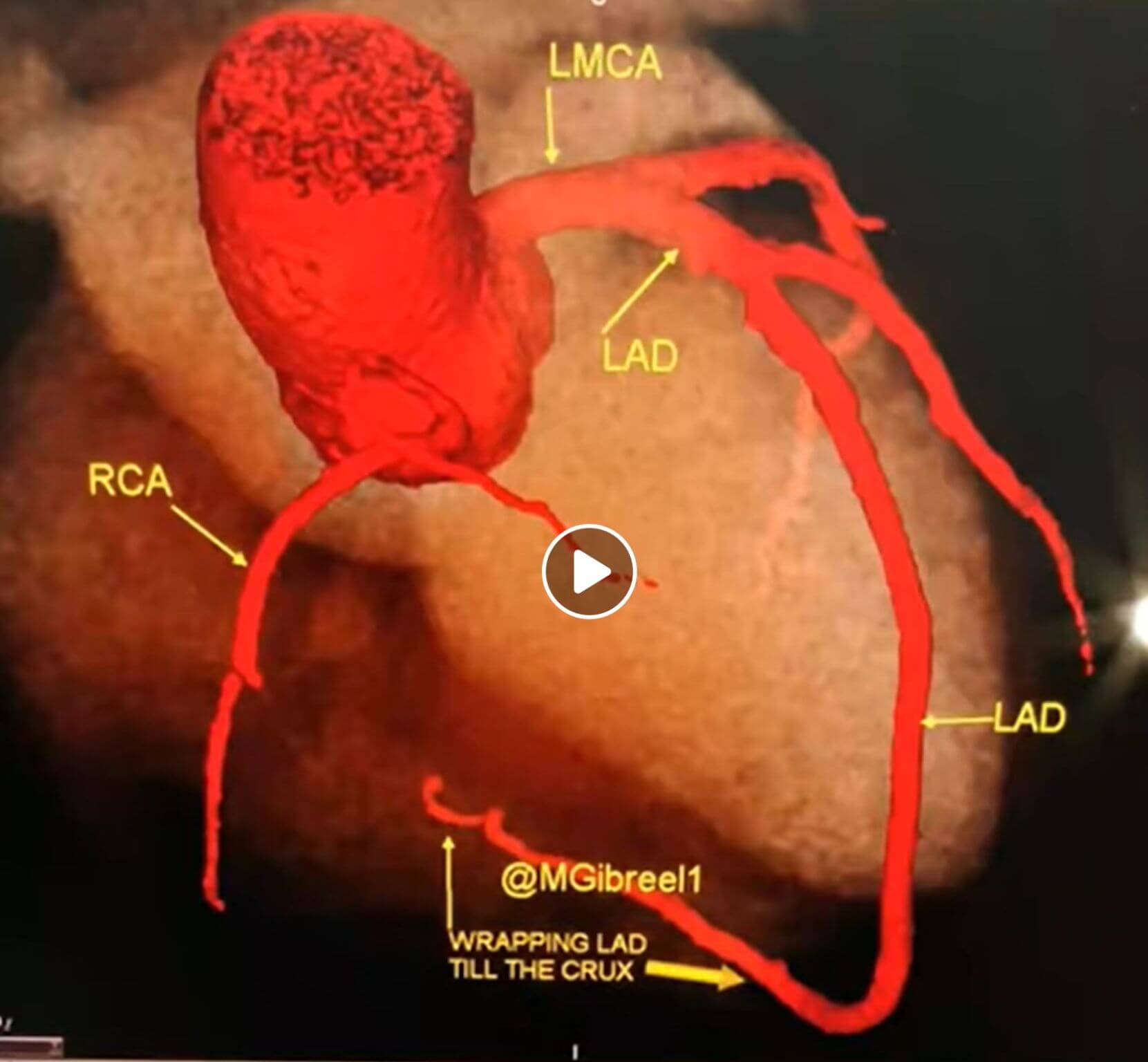 Replaced coronaries & super-dominance - Perfusfind