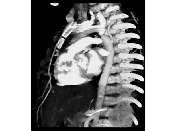 Aortic coarctation - CT angiography - Perfusfind