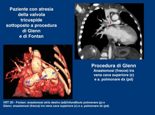 Glenn and Fontan on Tricuspid Heart Valve Atresia - Perfusfind