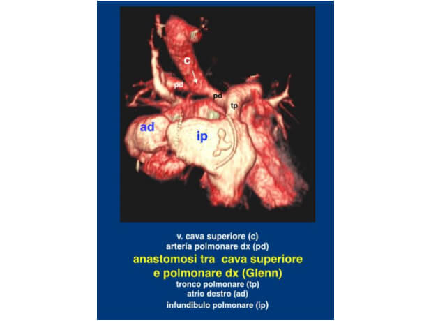 Glenn and Fontan on Tricuspid Heart Valve Atresia - Perfusfind