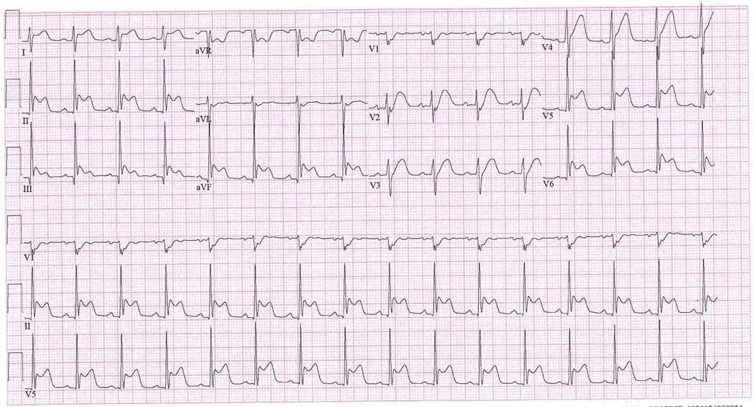 Diffuse ST-Segment Elevation With Idiopathic Malignant Ventricular ...