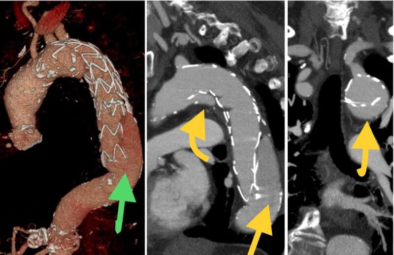 TEVAR - Type IA and Type IB endoleak - Perfusfind