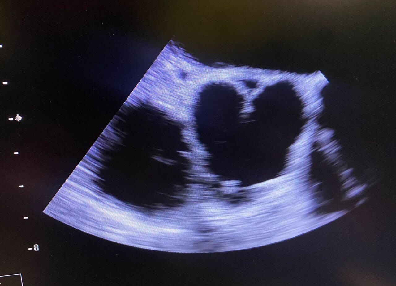 Ascending aorta aneurysm and dissection undergone philadelphia ...