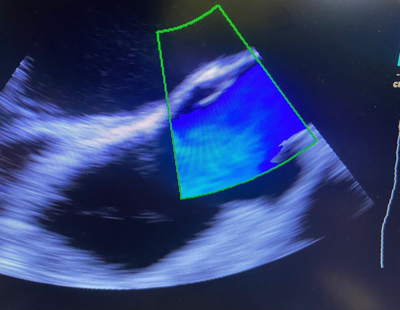 Ascending aorta aneurysm and dissection undergone philadelphia ...