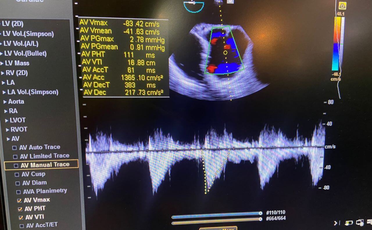 Ascending aorta aneurysm and dissection undergone philadelphia ...