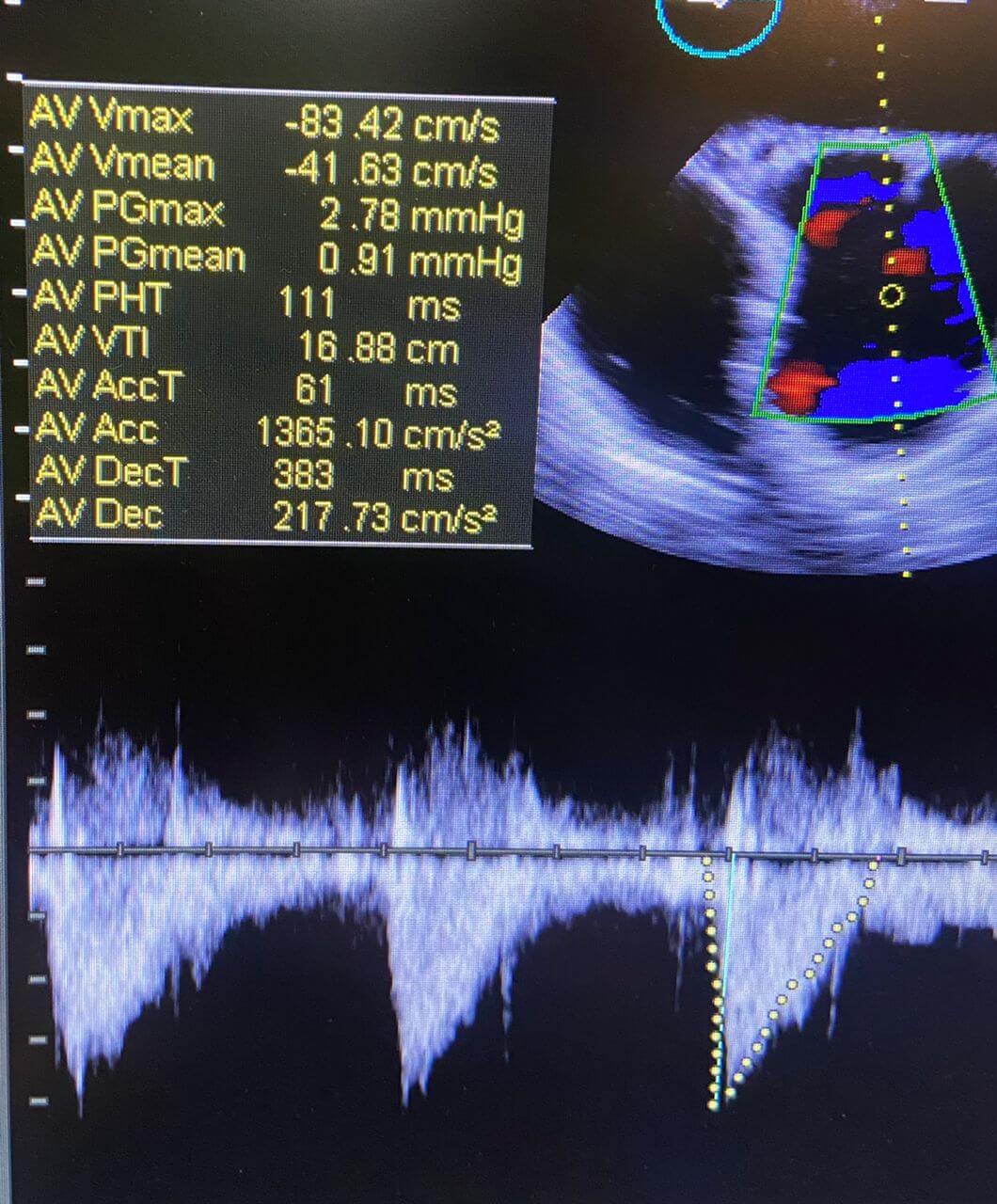Ascending aorta aneurysm and dissection undergone philadelphia ...