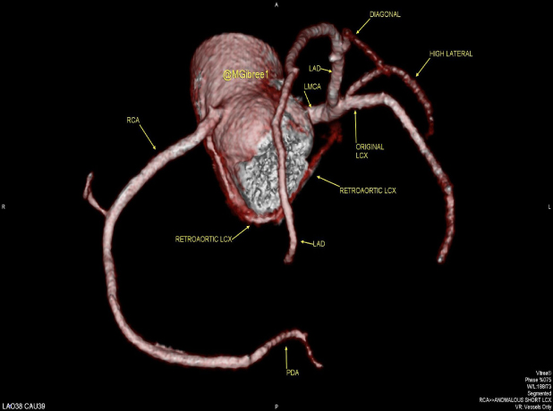 Twin LCX - Perfusfind