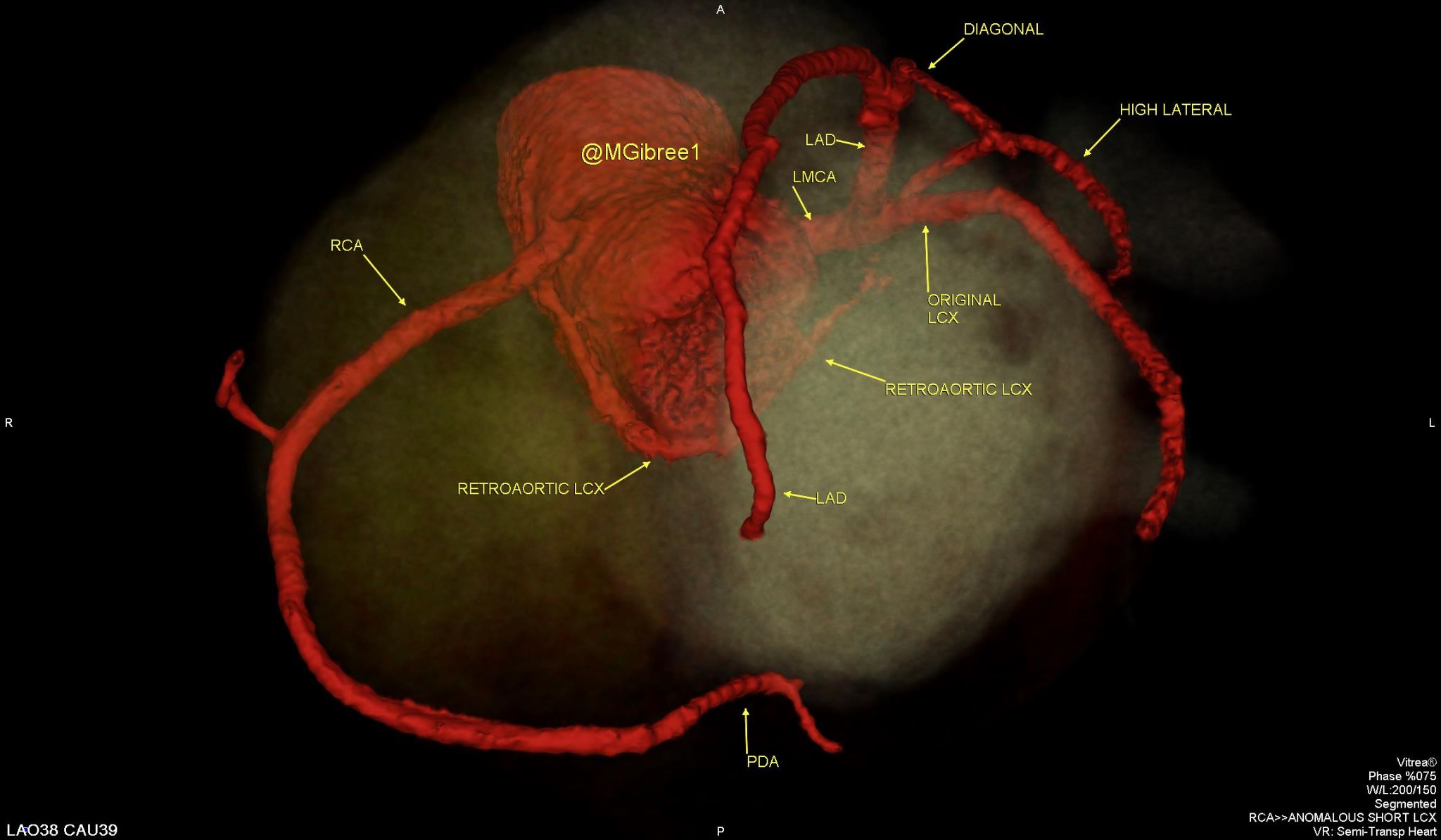 Twin LCX - Perfusfind